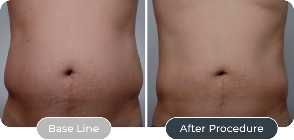 Ultraformer III | Micro Pulsed Technology | DUBIMED